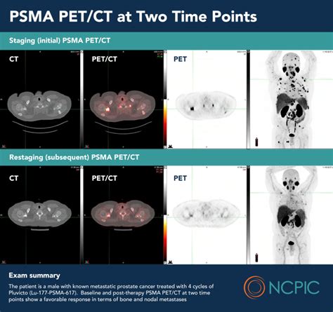 PSMA-PET Imaging for Prostate Cancer: Recent Advances and Key Updates ...